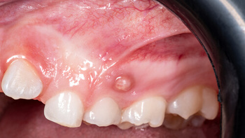 Tooth Abscess Drainage | Emergency Dentist Adelaide