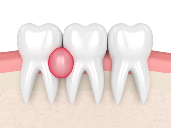 Tooth Abscess in Sinus Cavity: A Comprehensive Guide