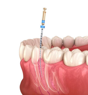Can You Have Surgery with a Broken Tooth? Key Insights